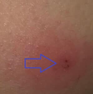 Camel Spider Bite: Symptoms And Treatment (with Pictures)